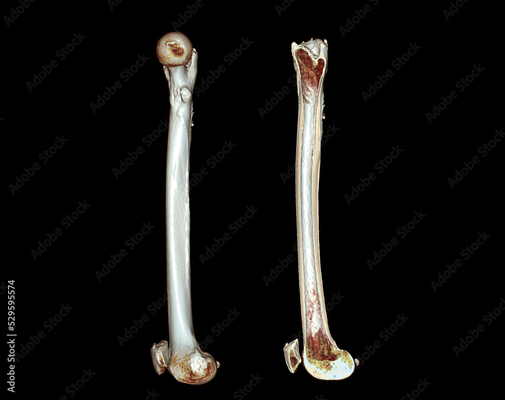 CT Scan of Femur of thigh bone 3D rendering image Stock Illustration ...