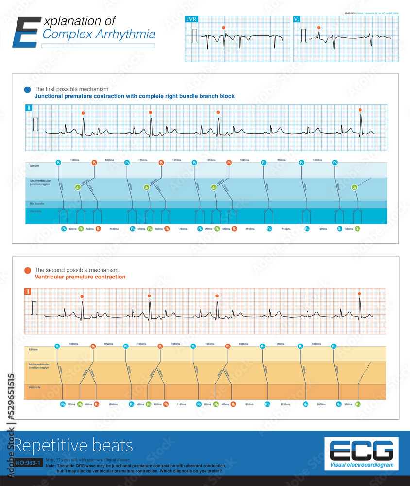 Ventricular and junctional premature contractions can activate the ...