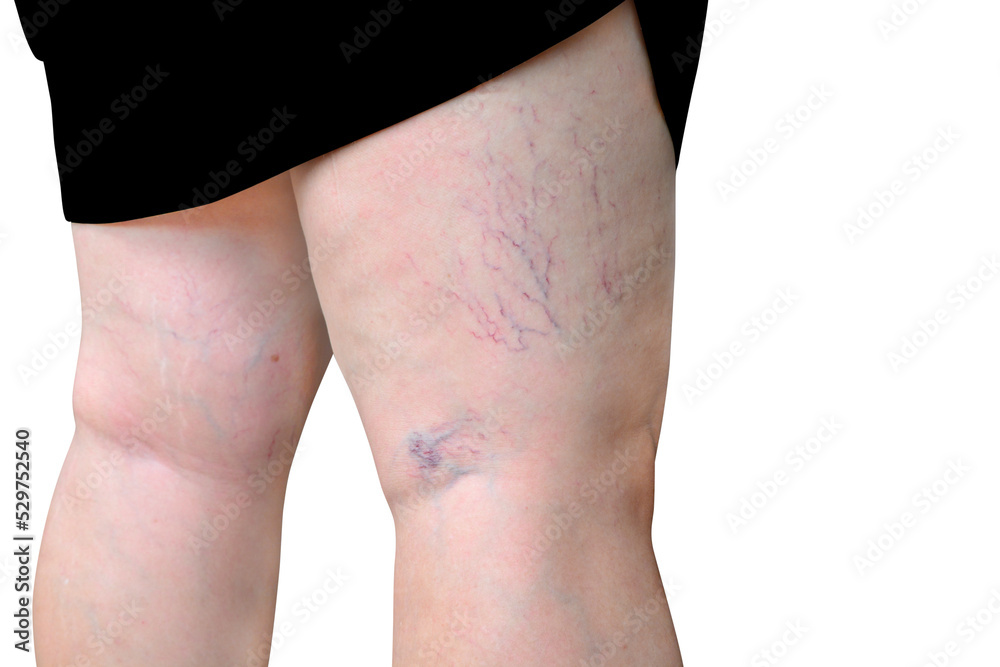 Woman exposing leg with varicose veins on leg capillary varicose veins ...