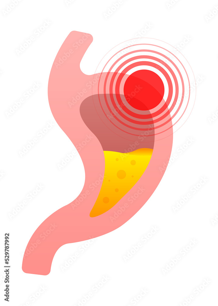Human stomach. Healthy and unhealthy. Digestive system anatomy. Vector ...