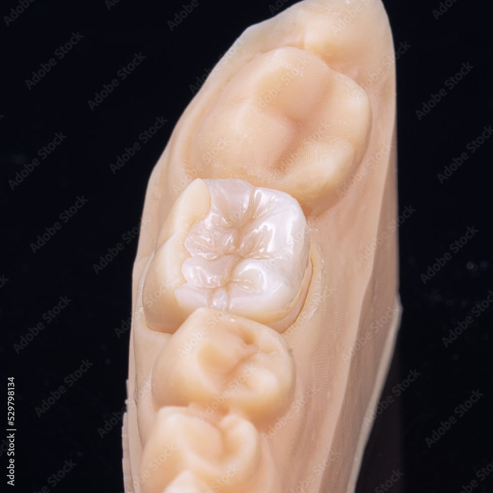 Composite onlay on 3d printed model Stock Photo | Adobe Stock