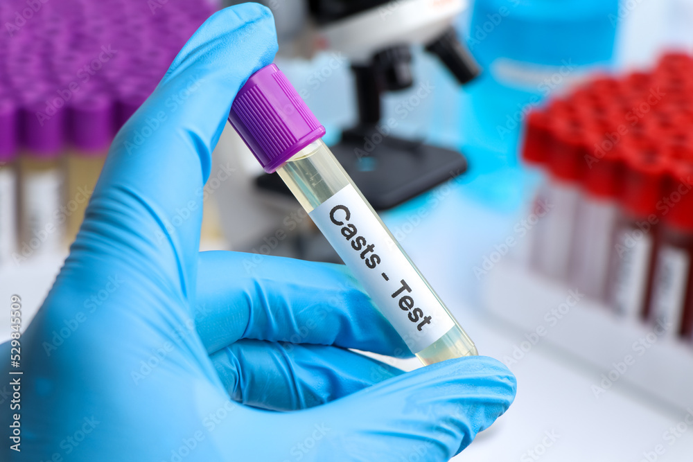 Urine samples for testing Casts in the laboratory Stock Photo | Adobe Stock