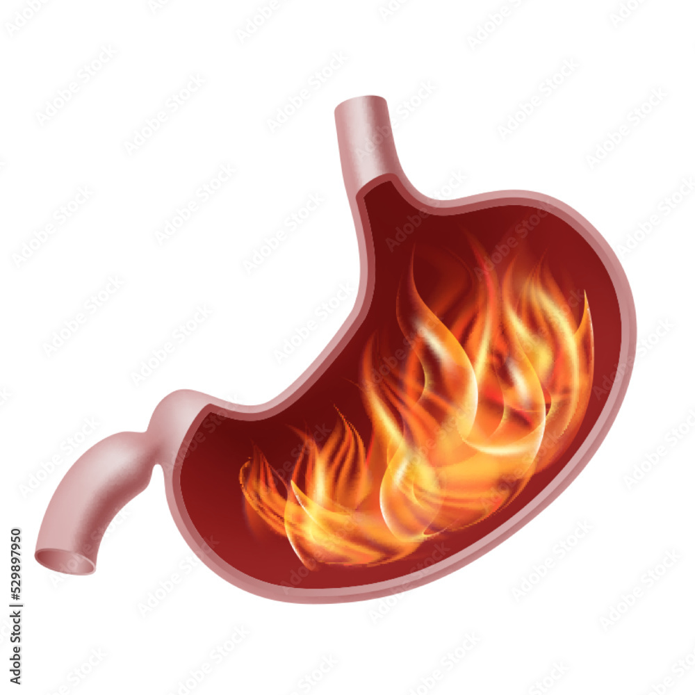 Burning stomach. Realistic human organ of internal digestion system on ...