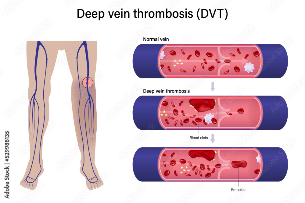Diagram of the legs with enlarged images of normal veins and deep vein ...