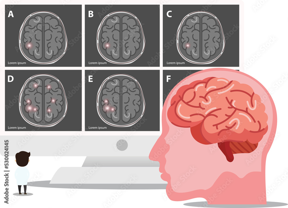 Hemorrhagic brain stroke concept. Apoplexy, cerebral hemorrhage, headache problem. Apoplectic ...