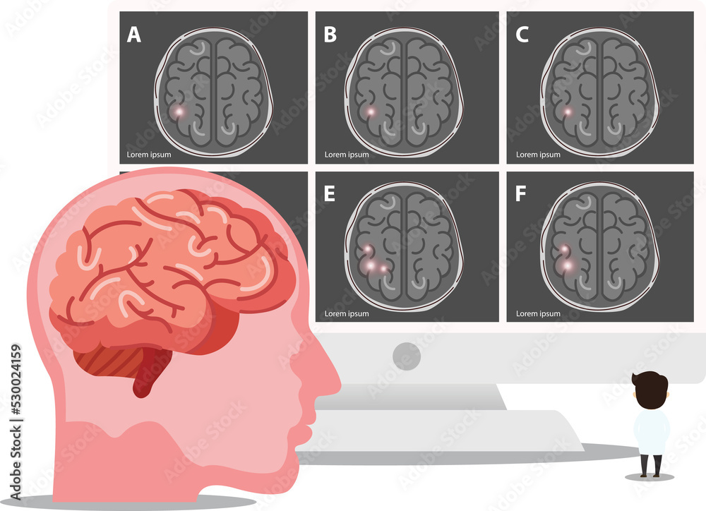 Hemorrhagic brain stroke concept. Apoplexy, cerebral hemorrhage ...
