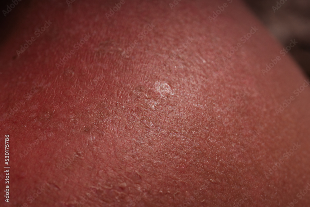 sunburn on the skin of a man. swollen skin from blisters on the boy's ...