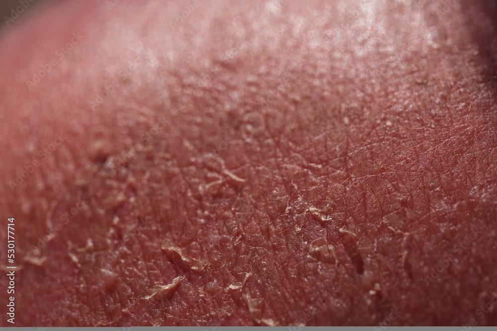 sunburn on the skin of a man. swollen skin from blisters on the boy's ...