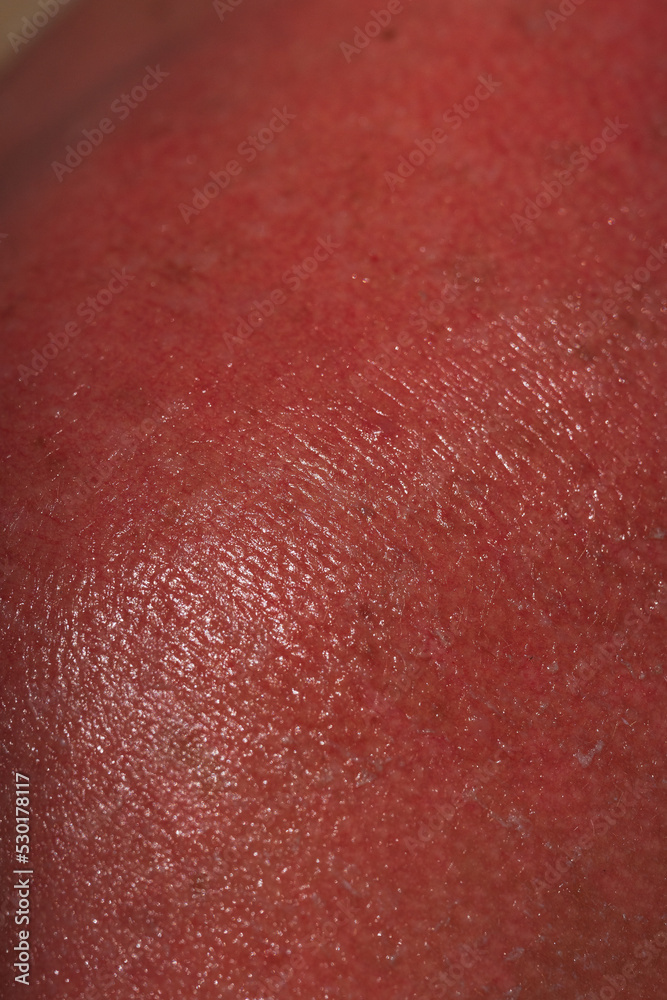 sunburn on the skin of a man. swollen skin from blisters on the boy's ...