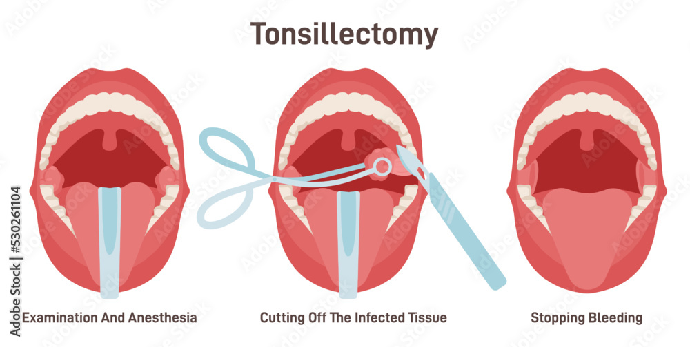 Tonsillectomy. Acute pharyngitis treatment, surgical removal of the tonsils, Stock Vector ...