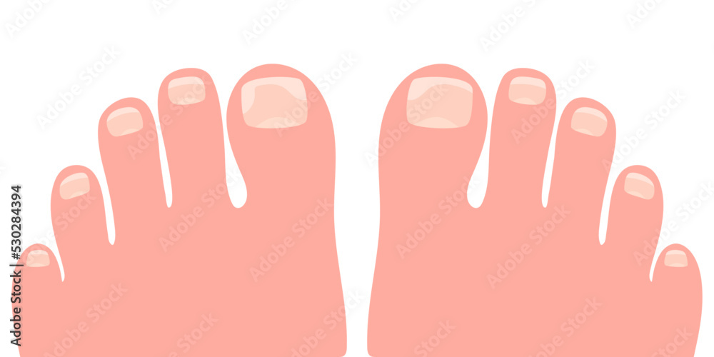 Bare foots with onycholysis on a toenails cartoon vector illustration ...