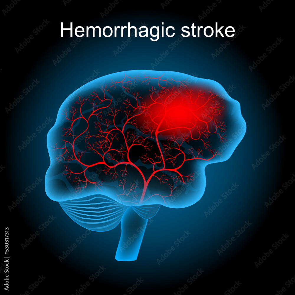 hemorrhagic stroke. human brain with blood vessels and hematoma vector ...