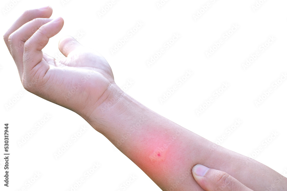 Swollen arms due to mosquito bites isolate on white background with ...