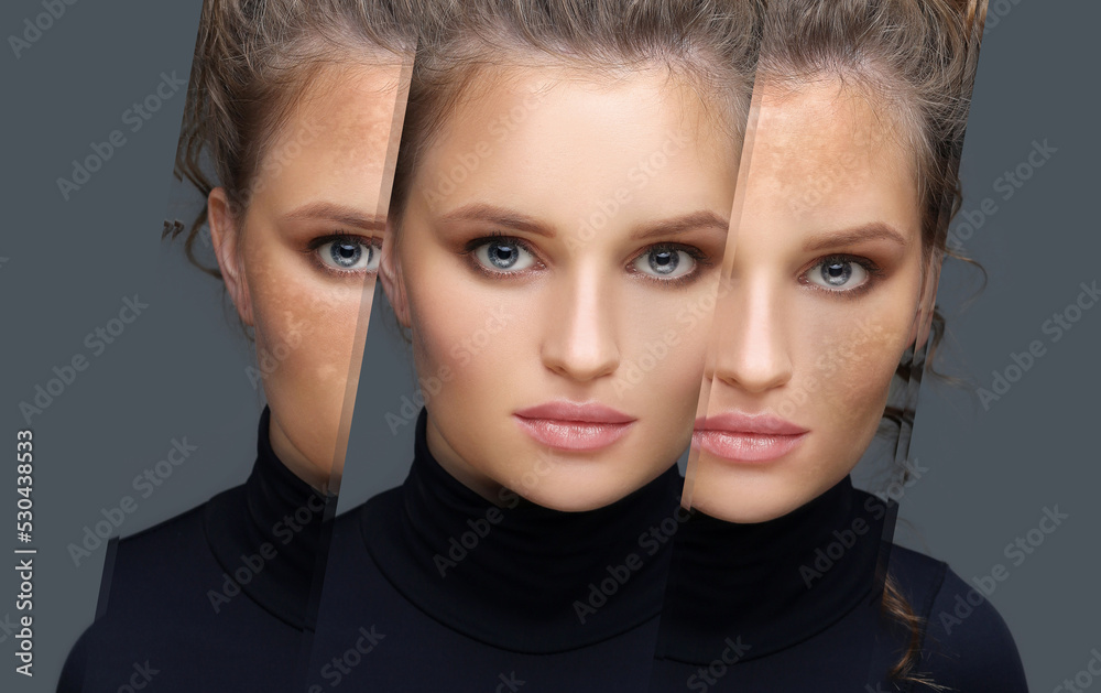 Dark spots, freckles,hyperpigmentation(melasma or chloasma),concept ...