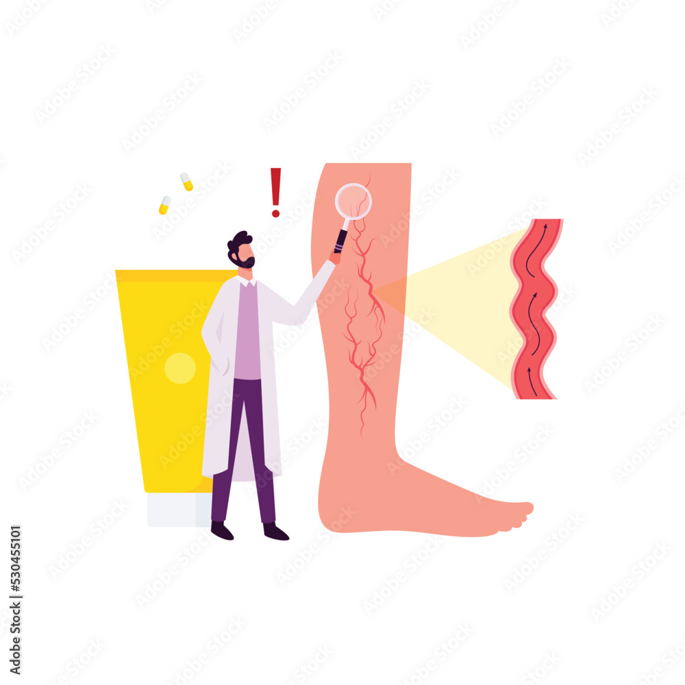 Vein Thrombosis and Varicose Treatment Concept. Tiny Doctor Character ...