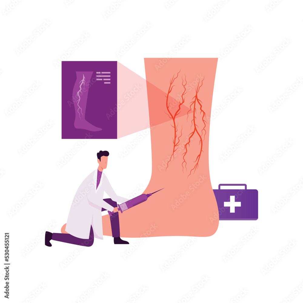 Vein Thrombosis and Varicose Treatment Concept. Tiny Doctor Character ...