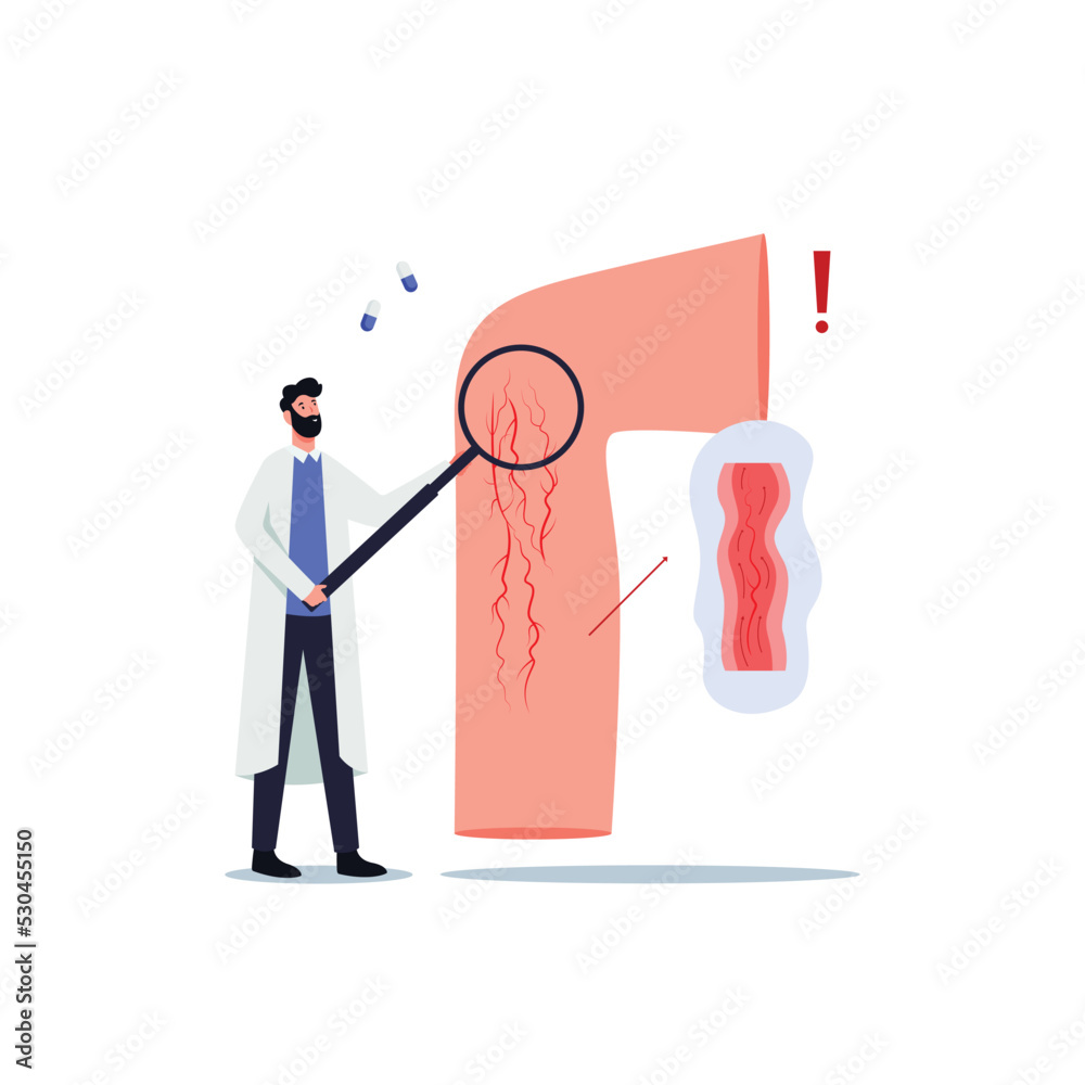 Vein Thrombosis and Varicose Treatment Concept. Tiny Doctor Character ...