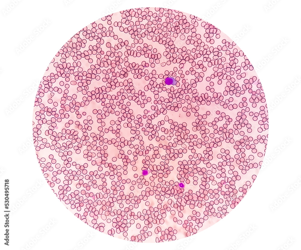 Microscopic view of hematological stained slide. thrombocytopenia ...