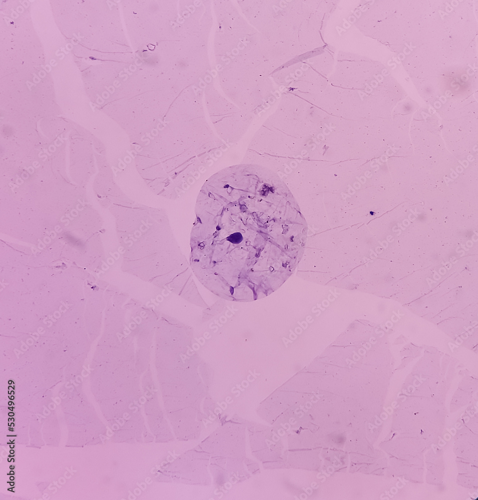 Lower flank cytology: Lipoma, benign growth of fatty tissue, benign ...