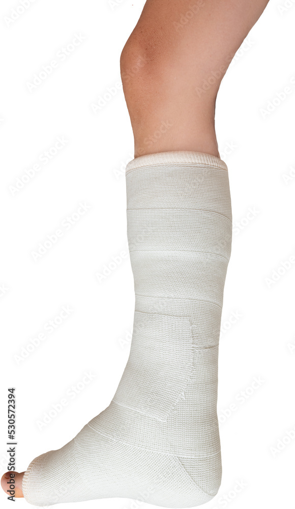 Woman with her broken leg. leg in a cast on isolated white background ...