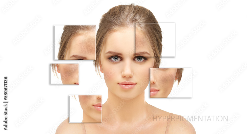 Dark spots, freckles,hyperpigmentation(melasma or chloasma),concept ...