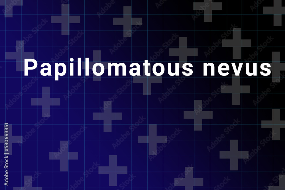 Papillomatous nevus disease Illustration. Papillomatous nevus title on ...