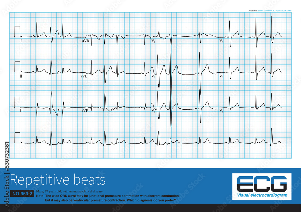 Repetitive beats.Ventricular and junctional premature contractions can ...