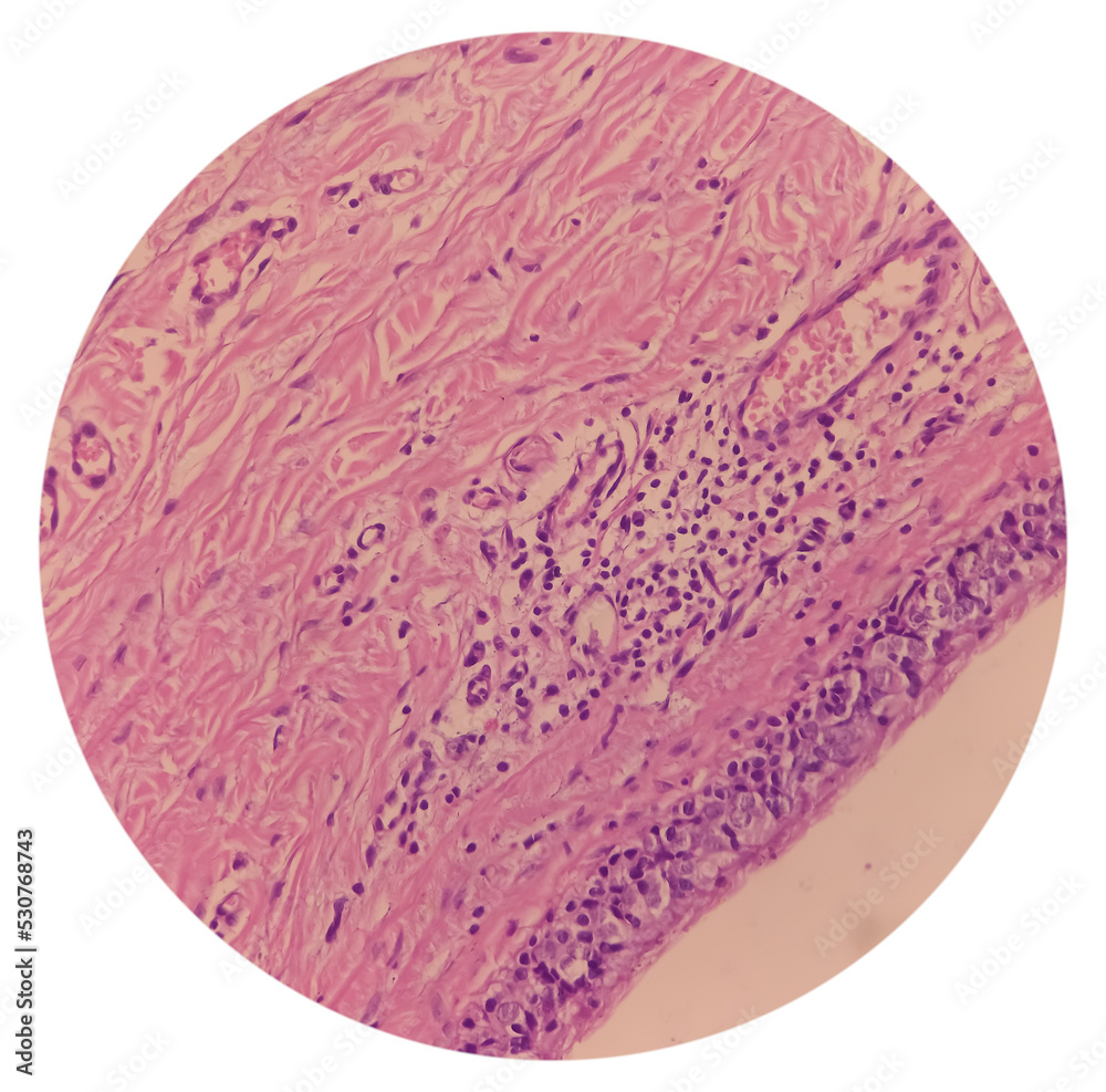 Microscopic image of branchial cyst, branchial sinus, show cyst wall of ...