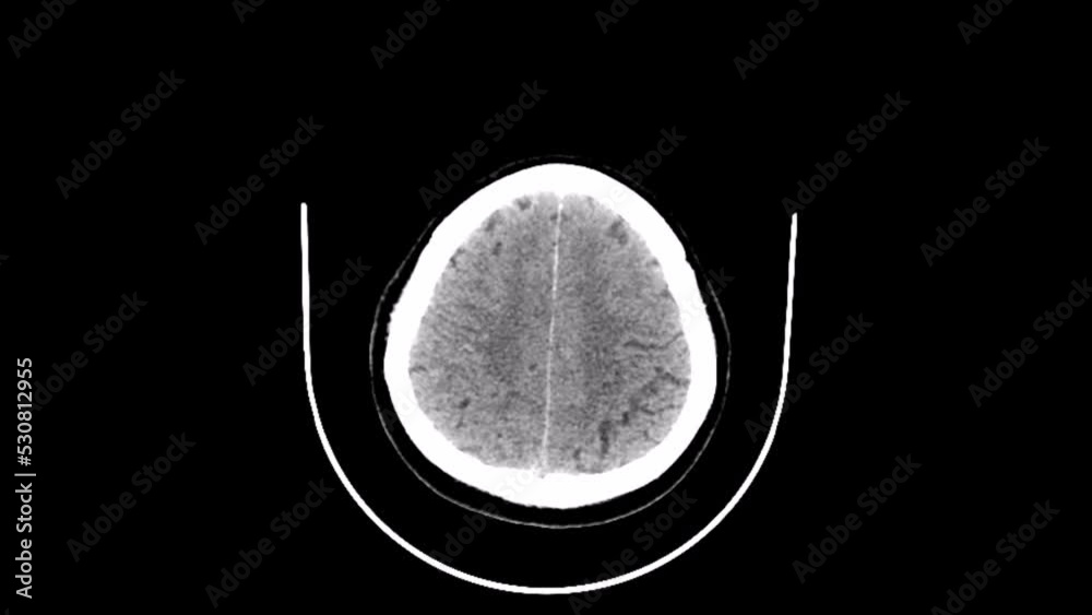 cerebral vascular malformation, arteriovenous malformation, intra ...