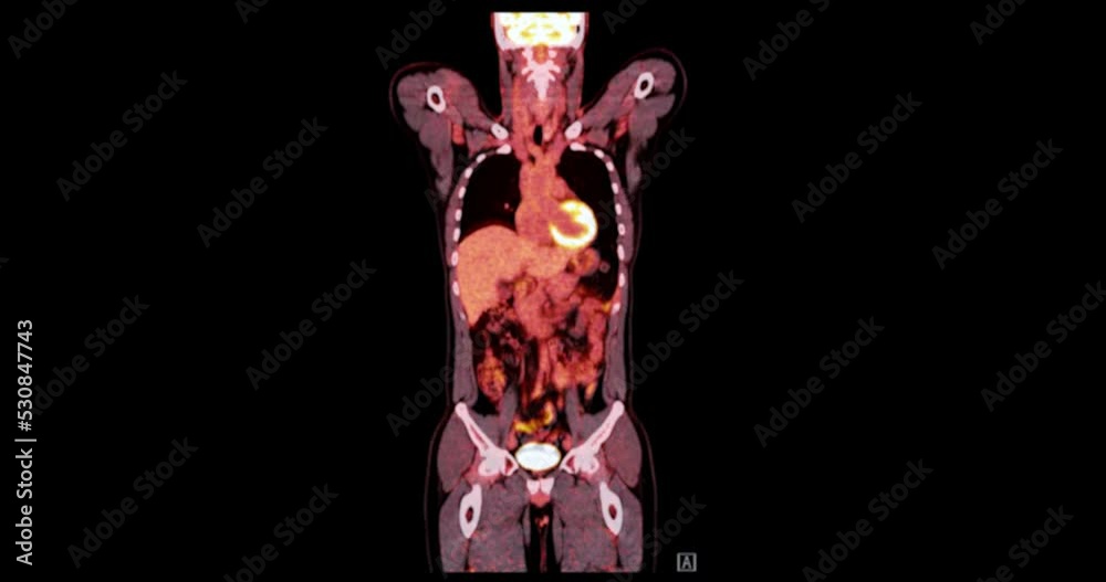 PET CT Scan fusion image of Whole human body for detect cancer ...