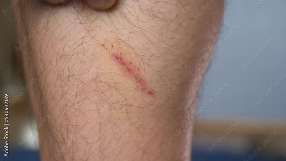 Scratch on skin after accident. Wound on unrecognizable male leg, calf ...
