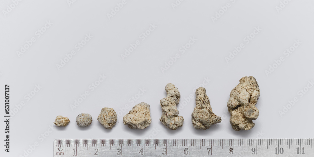 Kidney stones in different shapes from small to large.the concept of ...