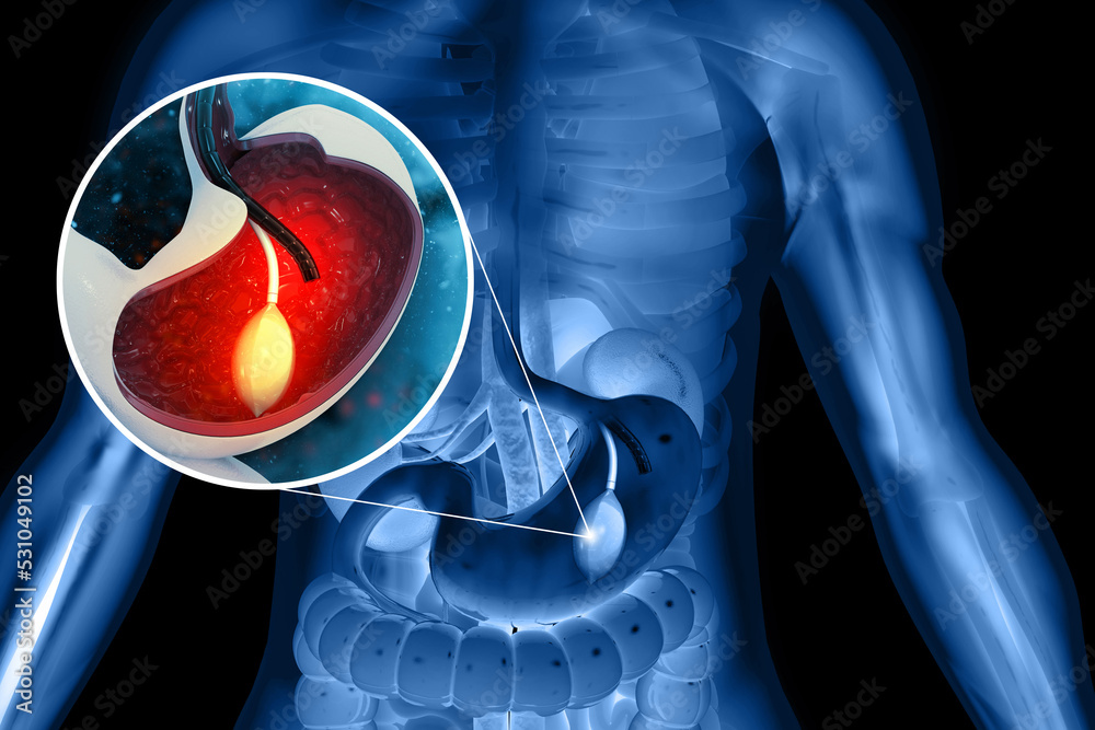 Stomach Endoscopy. Gastric Balloon Inside a Stomach. 3d illustration ...