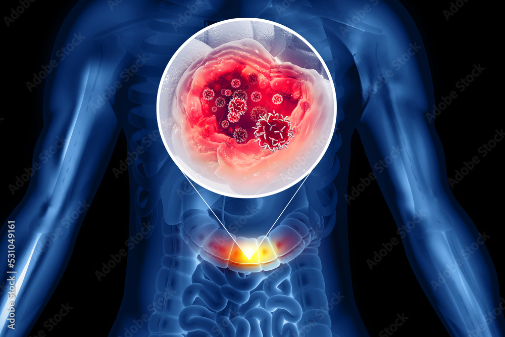 Colon cancer. Cancer attacking cell. Colon disease concept. 3d ...