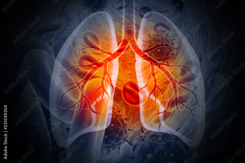 Medical Illustration showing lung cancer or bronchial carcinoma on ...
