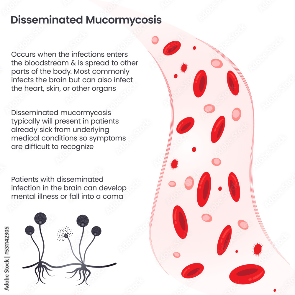 Disseminated Mucormycosis vector illustration informational graphic ...