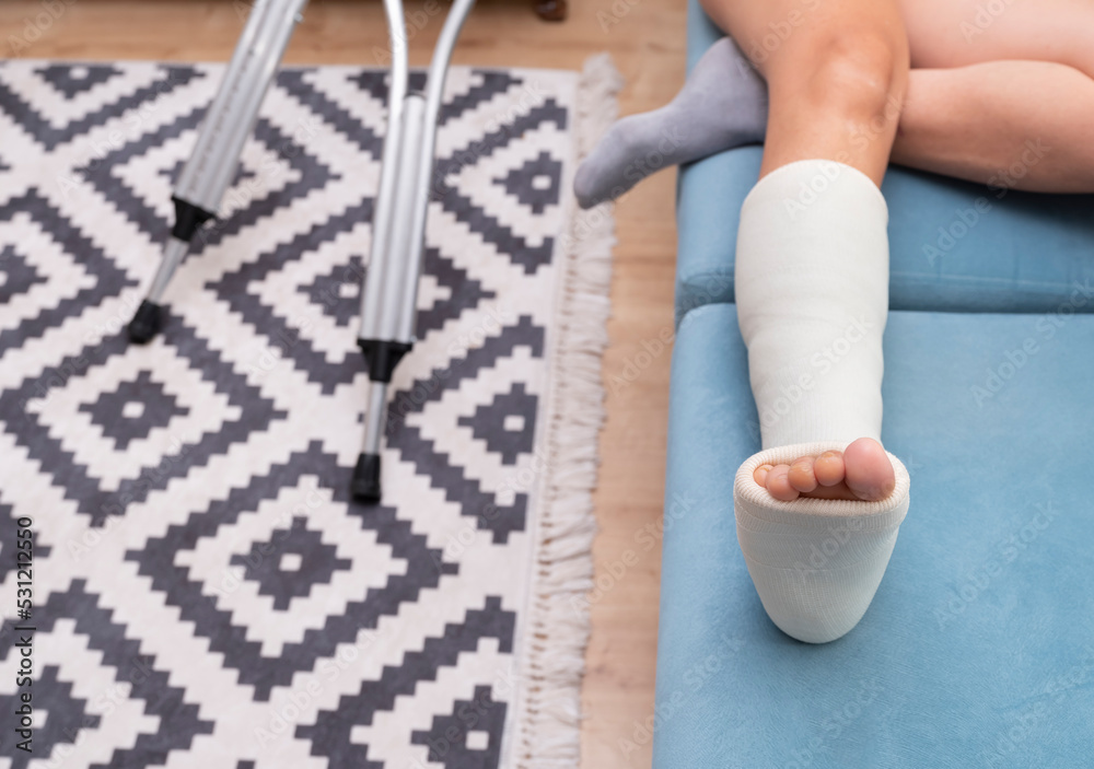broken ankle and a leg cast. Leg splint Stock Photo | Adobe Stock