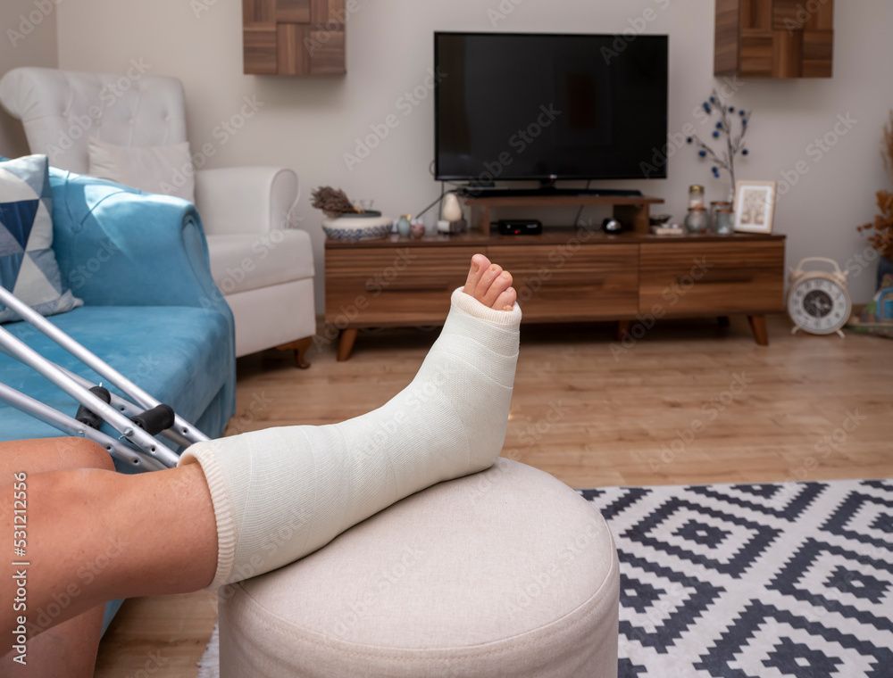 broken ankle and a leg cast. Leg splint Stock Photo | Adobe Stock