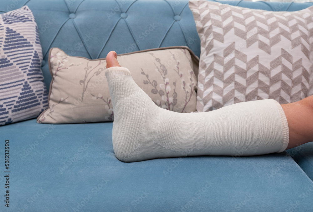 broken ankle and a leg cast. Leg splint Stock Photo | Adobe Stock