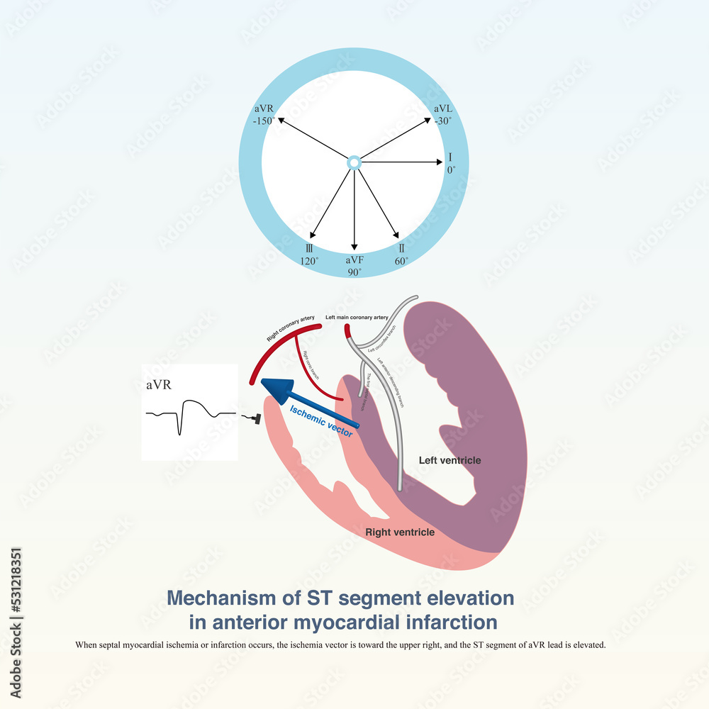 Obraz Acute left main trunk occlusion, acute left anterior descending ... Obraz Acute left main trunk occlusion, acute left anterior descending ...