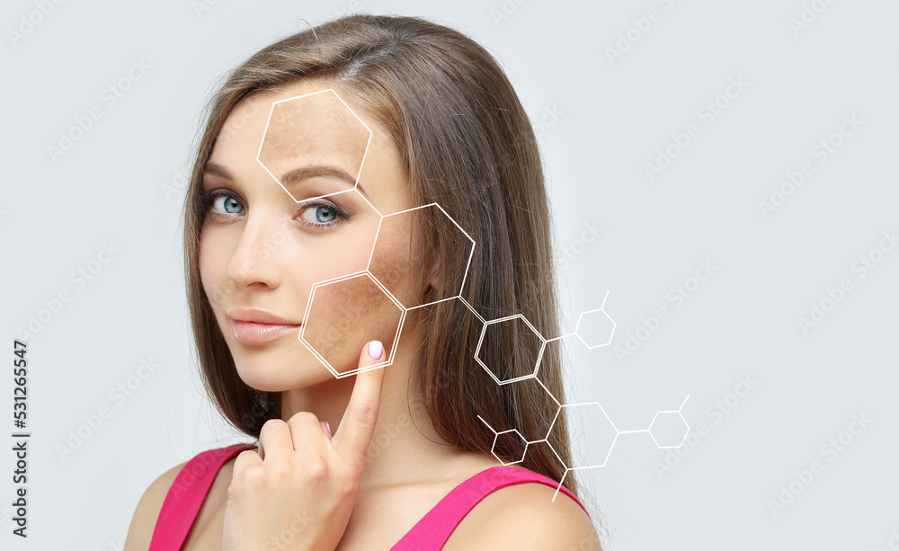 Dark spots, freckles,hyperpigmentation(melasma or chloasma),concept ...