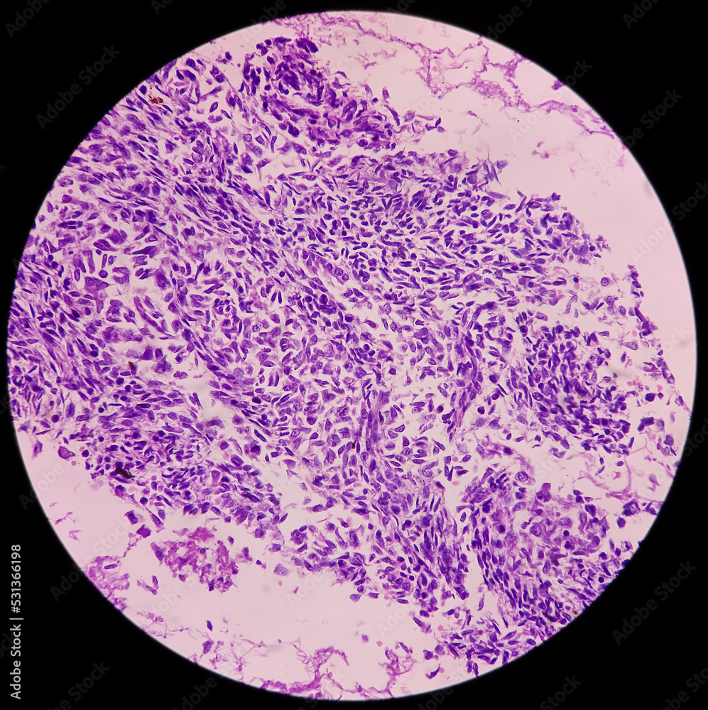 Uterus biopsy: Chronic cervicitis, proliferative phase, leiomyoma ... Uterus biopsy: Chronic cervicitis, proliferative phase, leiomyoma ...