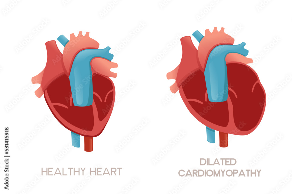 Plakát Healthy human heart and heart with dilated cardiomyopathy ...