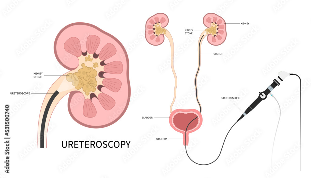 Kidney catheter biopsy stone removal uric acid Blocked ureter Painful ... Kidney catheter biopsy stone removal uric acid Blocked ureter Painful ...