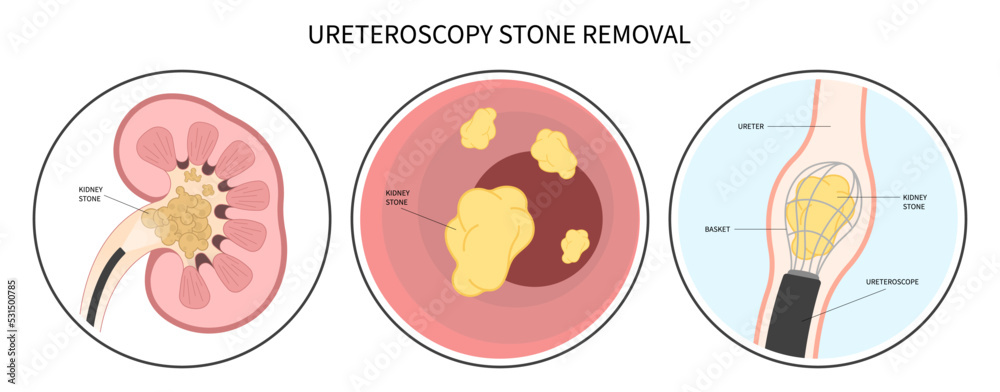 Kidney Painful treatment stone removal uric acid Blocked ureter ...