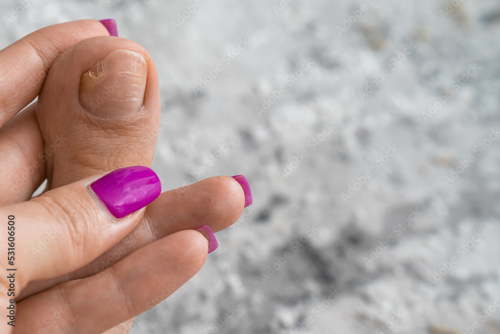 person feet close up, fungus, broken nail, skin infection, toe mycosis ...