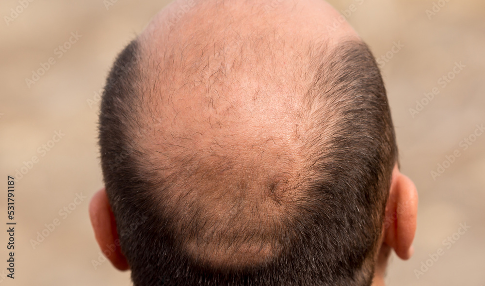 Bald head nape head baldness, hair transplant hair loss, stress Stock ...