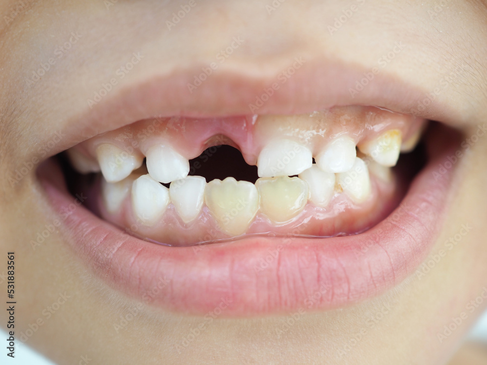 Kid patient open mouth showing cavities teeth decay. Caused by unclean ...
