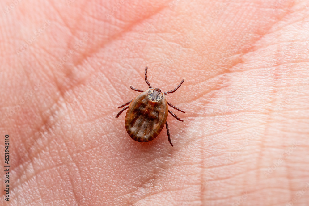Infectious Encephalitis Tick Insect on Skin. Encephalitis Virus or Lyme ...