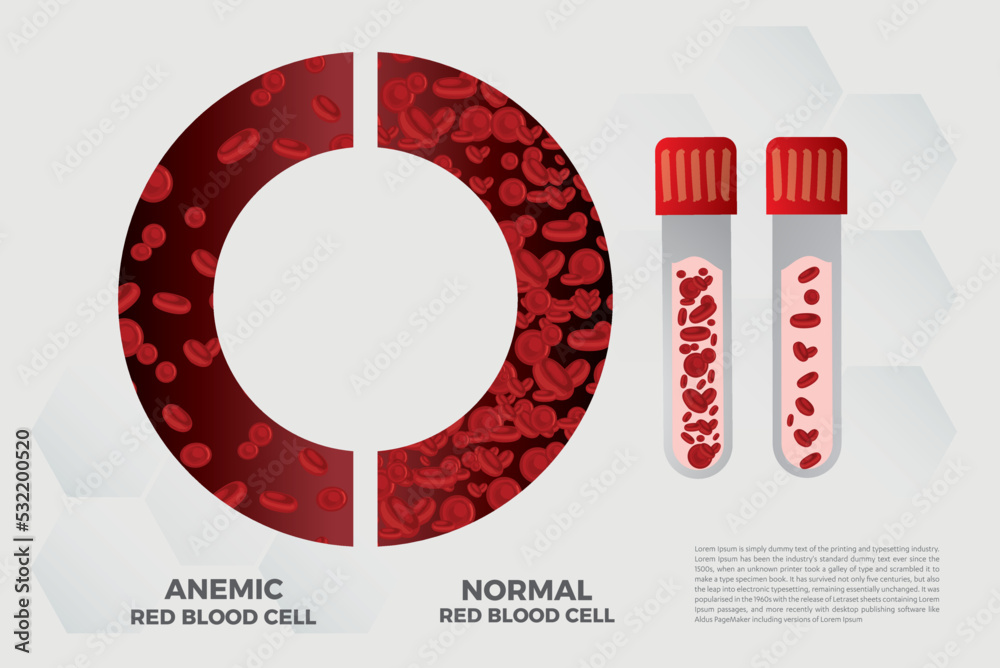 Poster Anemia Iron red blood cell medical vector illustration medical ...